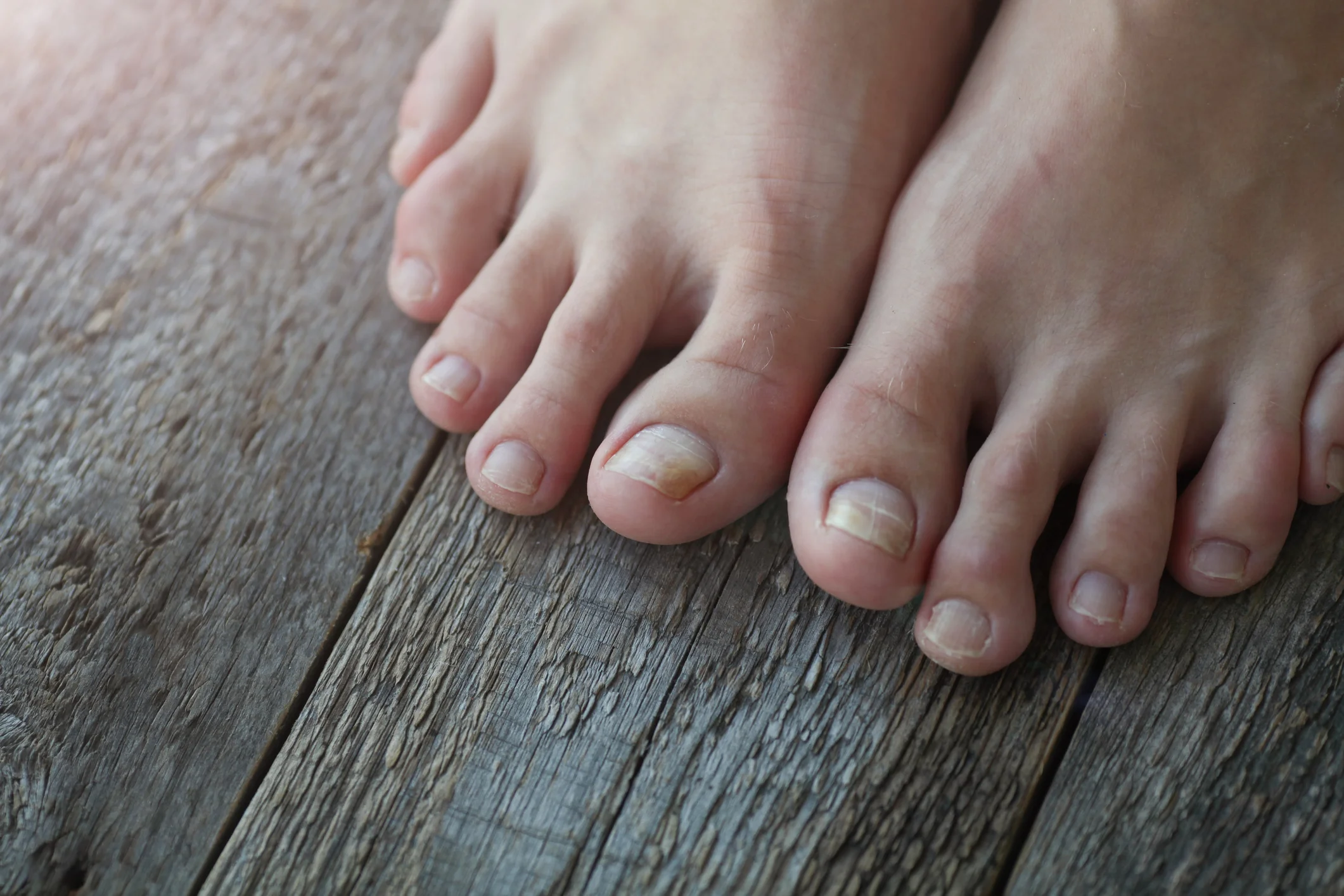 Yellow toenails treatment store