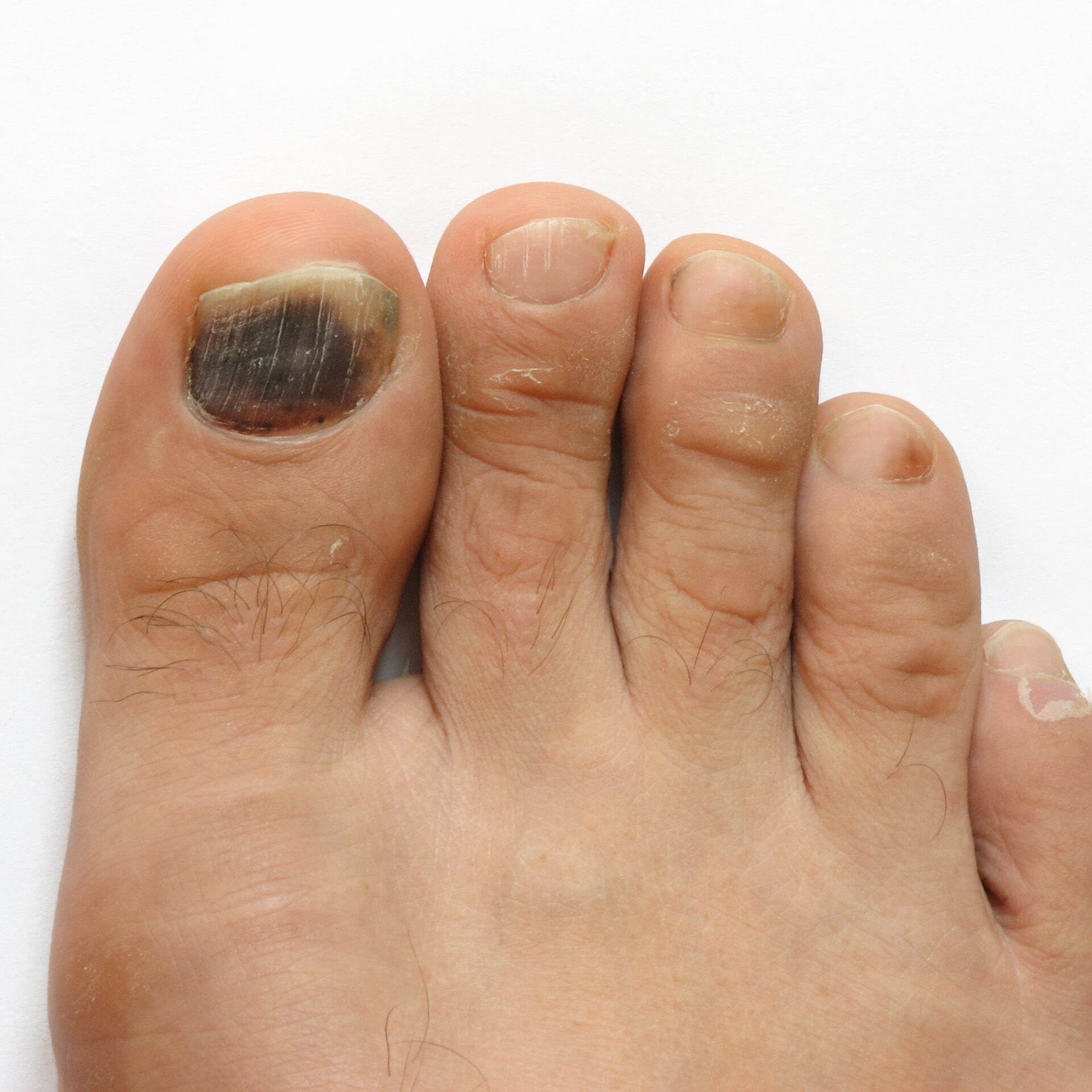 Thick Toenail Treatment Discoloured Toenail Remedy
