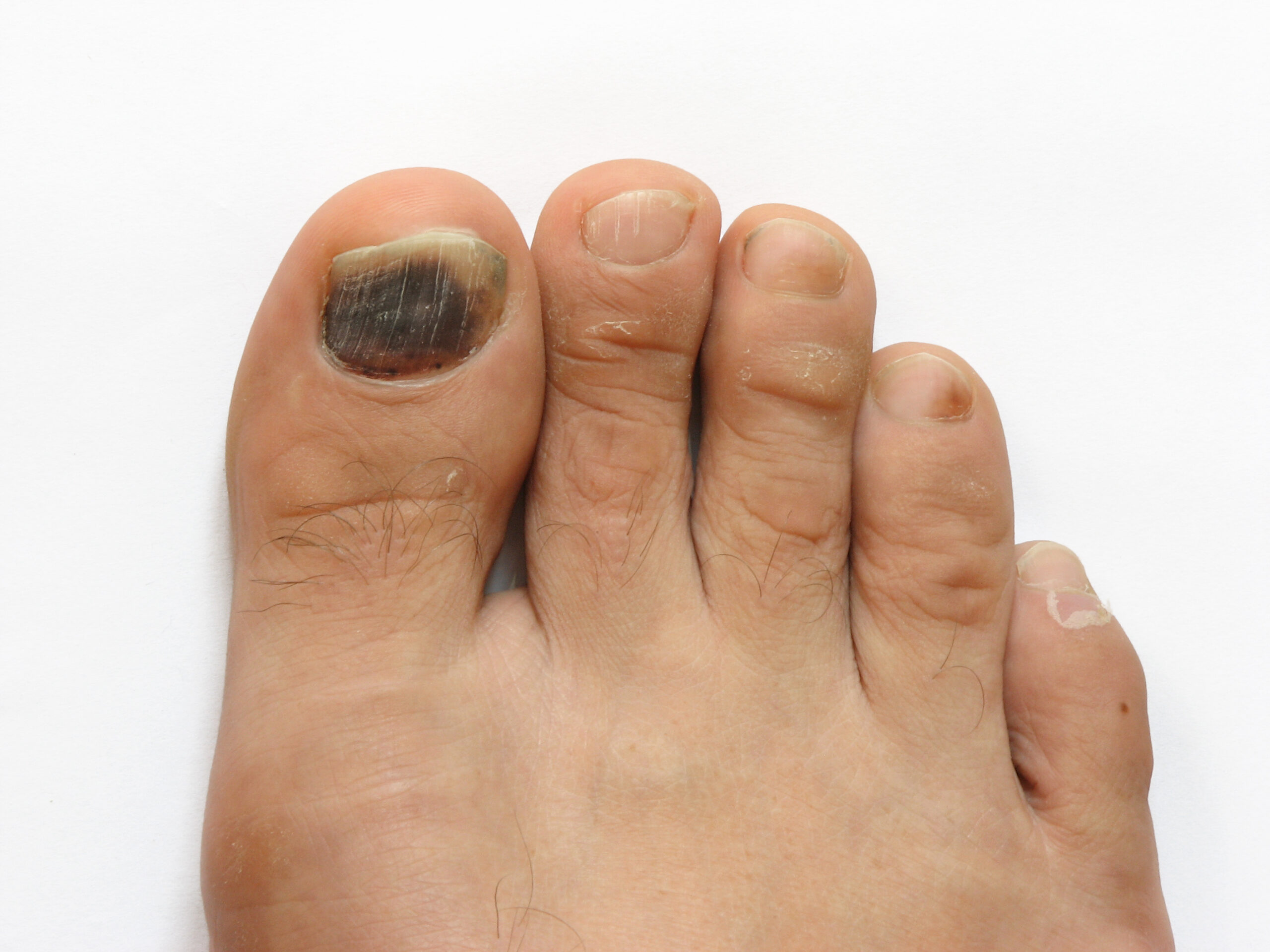 Thick Toenail Treatment Discoloured Toenail Remedy