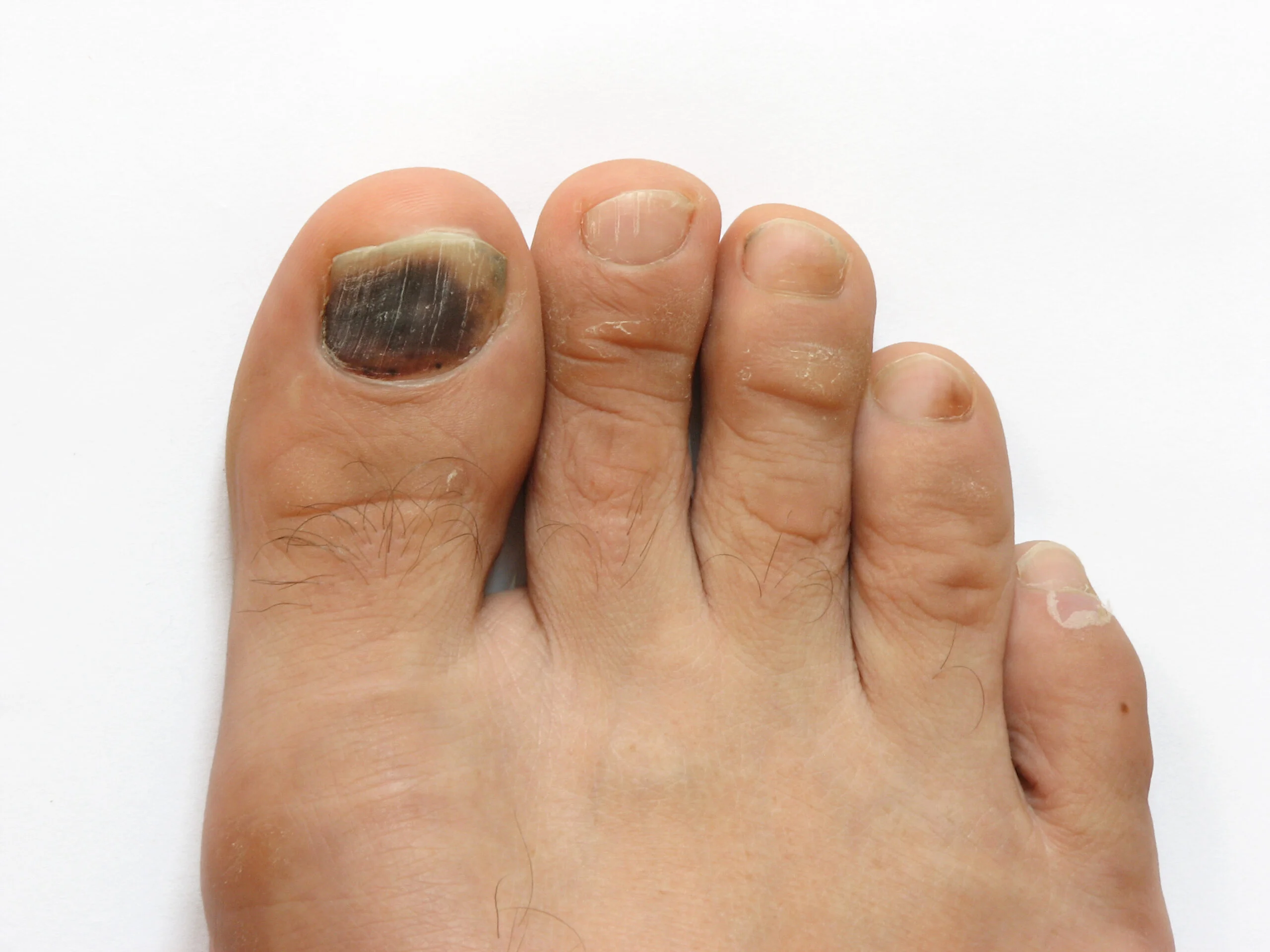 Thick Toenail Treatment Discoloured Toenail Remedy